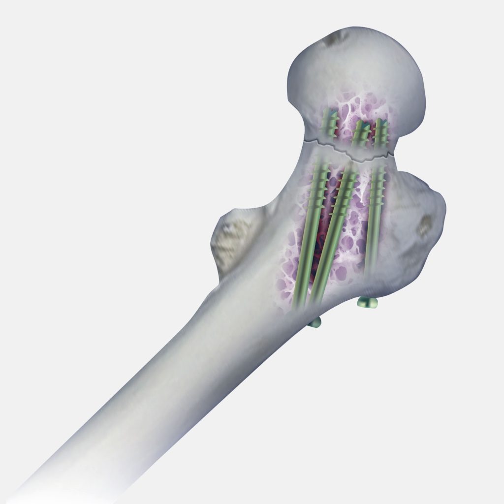 Standard Trauma | SiS medical Co., Ltd.