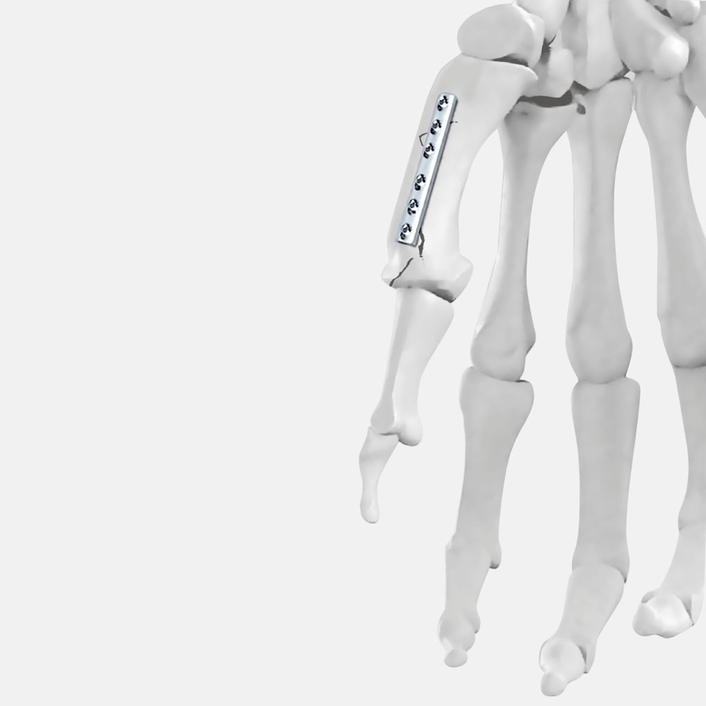 Standard Trauma | SiS medical Co., Ltd.