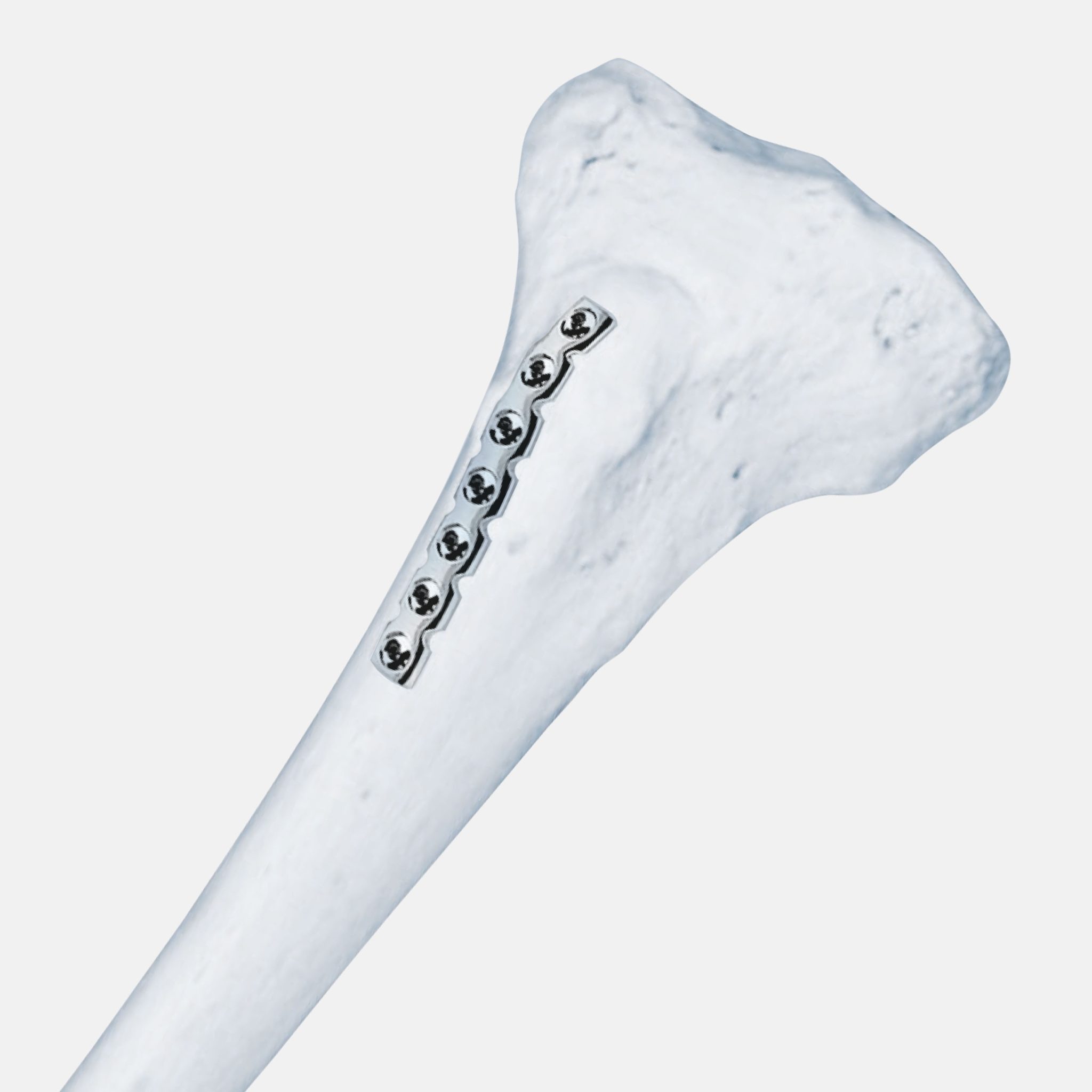 Standard Trauma | SiS medical Co., Ltd.